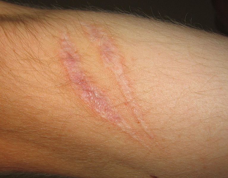 Abnormal Dermal Scarring - AgeVital.com